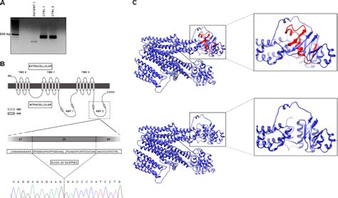 A Novel Abcc6 Variant Causative Of Pseudoxanthoma Elasticum Human Genome Variation