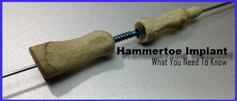 Hammertoe Implant What You Need To Know London Foot And Ankle Surgery