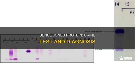Bence Jones Protein Urine Test And Diagnosis Medshun
