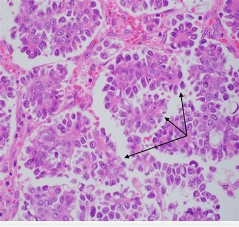 Specimen Histology Showing Papillary Structures Black Arrows Download Scientific Diagram