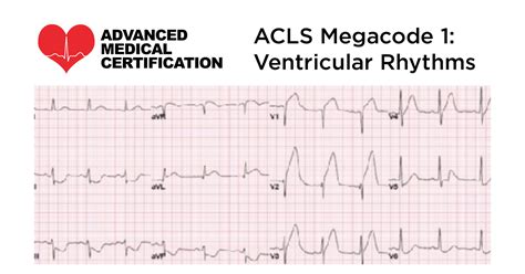 Acls Megacode Ventricular Rhythms