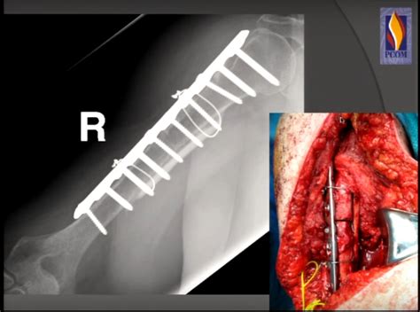 Principles Of ORIF For Proximal Humerus Fractures OrthopaedicPrinciples Com