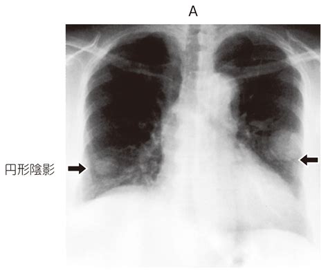 99a14 肺動静脈廔 国試 M3e Medical