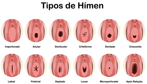 Tipos De Himen Para Entender Esta Membrana Doctor Online