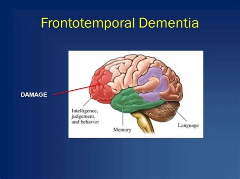 Frontotemporal Dementia A Comprehensive Guide