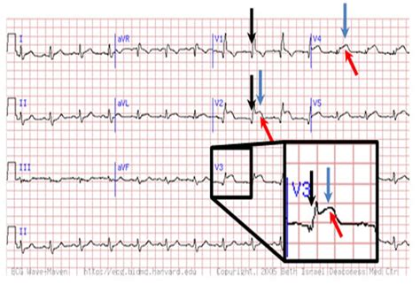 Are You Missing Subtle Mi Clues On Ecgs Test Your Skills