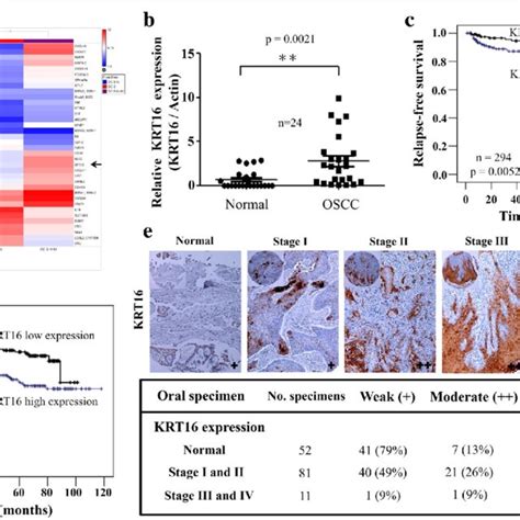 Krt16 Expression And Its Clinical Significances In Oscc A Heat Map Of