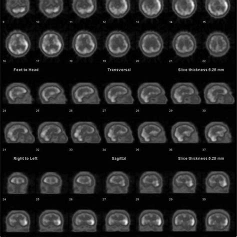 Pdf Cerebral Hyperperfusion Syndrome