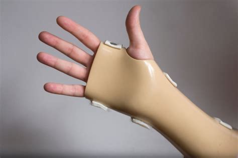 Metacarpal Fracture Treatment In Quezon City Tec Orthopedics