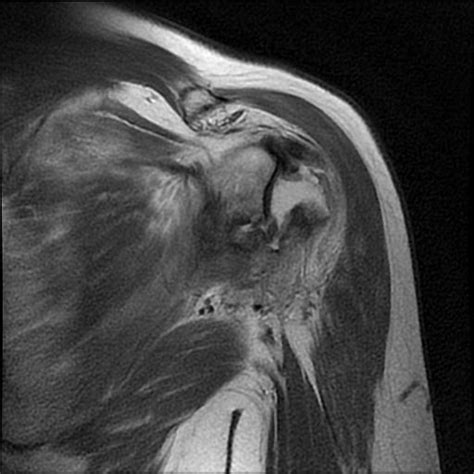 Bankart Lesion Mri