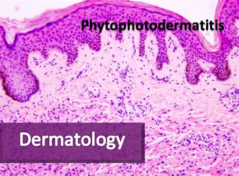 Phytophotodermatitis — Nuem Blog