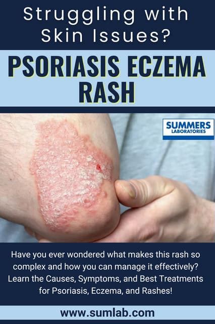 How Can You Tell The Difference Between Seborrheic Dermatitis And Psoriasis Pdf