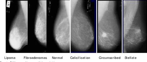 Figure 1 From Morphological Analysis Of Mammograms Using Visualization Pipelines Semantic Scholar
