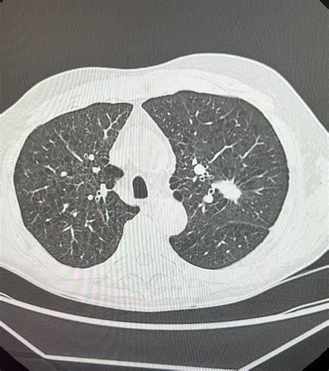 Lung Nodules And Cancer In Rancho Mirage My Wordpress