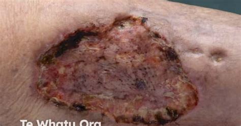 Pyoderma Gangrenosum Image