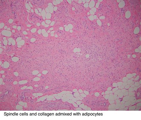 Pathology Outlines Fibrous Obliteration