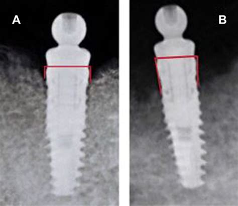 Impact Of Platform Switched Implants Ccide