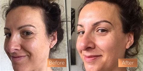 Absolute Collagen Before And After Pictures Incredible Results