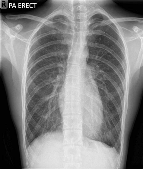 Initial Cxr Demonstrating A Small Apical Left Sided Pneumothorax