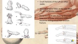 Phalangeal Fractures Of Hand Pptx