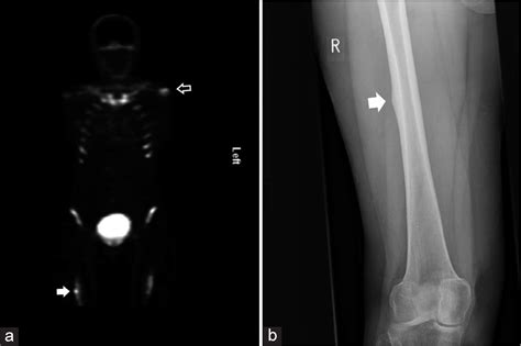 Atypical Fractures Secondary To Bisphosphonate Therapy A Case Series And Pictorial Review