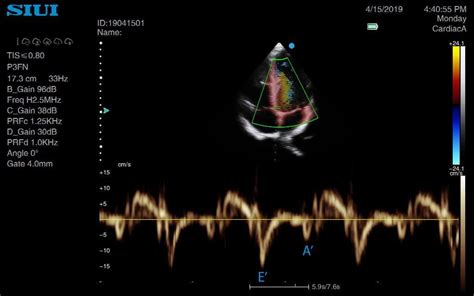 Assessing Diastolic Function With Echocardiography Portable Ultrasound Machines
