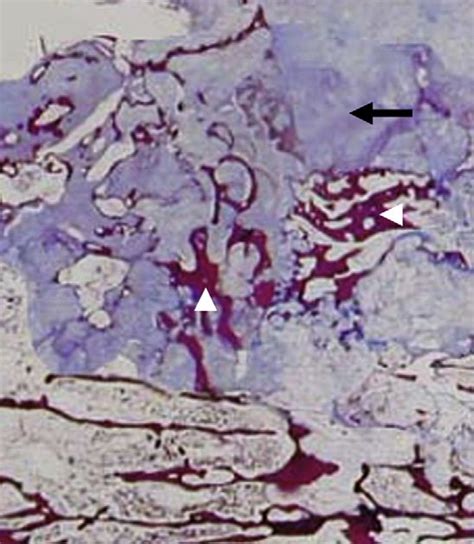 Histological Section Revealing A Partially Calcified Enchondroma Black Download Scientific