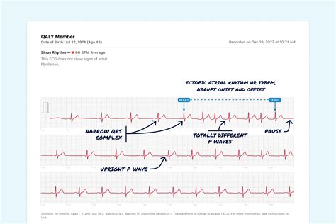 Ectopic Atrial Rhythm Vs Supraventricular Tachycardia Non Sustained