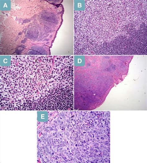 A Primary Cutaneous Follicular Lymphoma Follicular Pattern Of Growth
