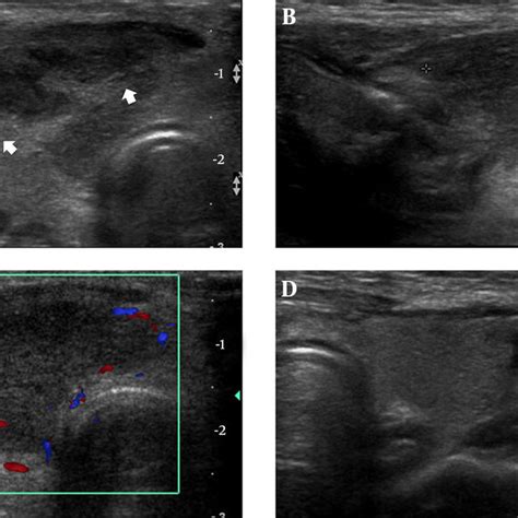 Technetium 99m Pertechnetate Thyroid Scan Shows Large Photon Defects Of Download Scientific