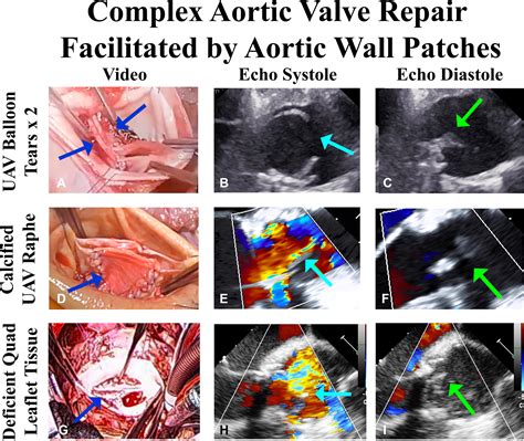 Use Of Aortic Wall Patches As Leaflet Replacement Material During