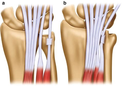 The Armdoc Extensor Carpi Ulnaris Subluxation