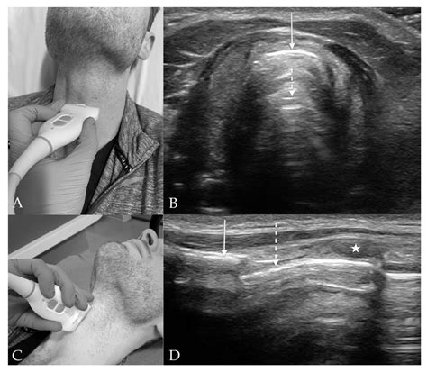 Cricothyroid View Transverse And Sagittal Orientations A