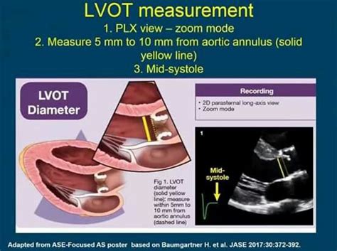 5 Steps To Identify Diastolic Dysfunction In Echo Artofit
