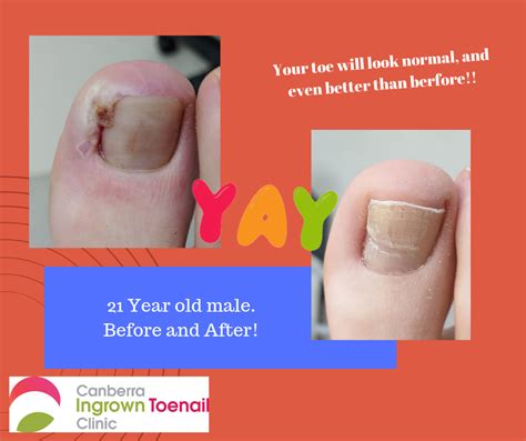 Canberra Ingrown Toenail Clinic 6 Months Post Surgery Citc