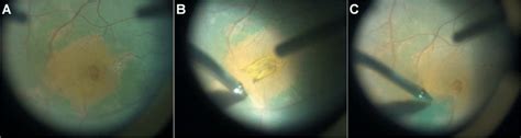 Peeling Of Atypical Epiretinal Tissue And Internal Limiting Membrane In Download Scientific