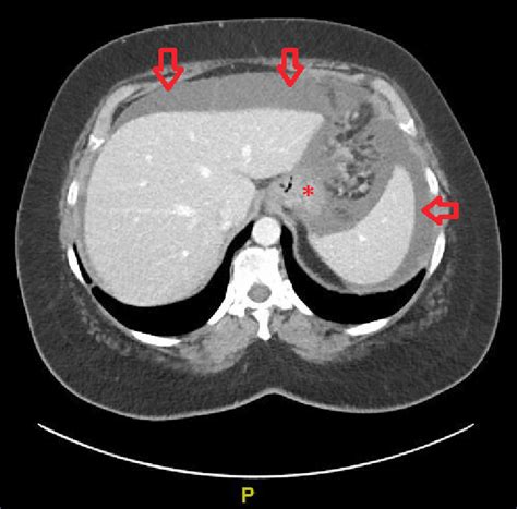 Axial View Of A Ct Abdomen Pelvis Extensive Ascites And Extensive