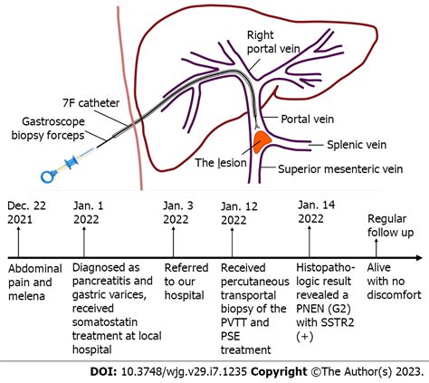 Percutaneous Transhepatic Intraportal Biopsy Using Gastroscope Biopsy