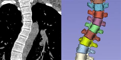 Automatic Segmentation And Identification Of The Vertebrae In Ct Scans Of Patients With Spinal