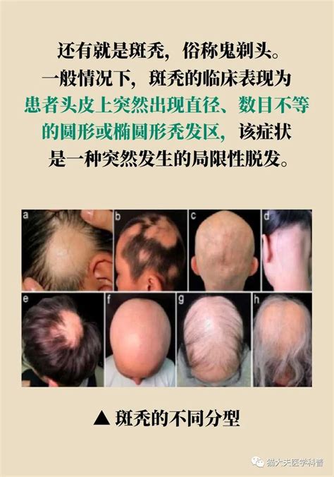 斑秃、全秃、普秃你的头发为什么要“叛逃”？澎湃号·湃客澎湃新闻 The Paper