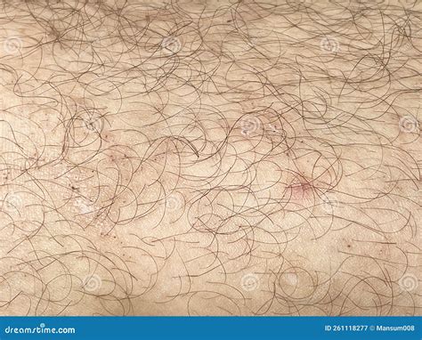 Scar On Human Body Stock Image Image Of Disease Grunge 261118277