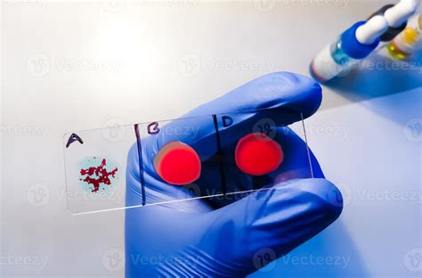 Un Groupe Sanguin Négatif Lun Des Rares Groupes Sanguins Dans Le Monde Test Du Groupe Sanguin