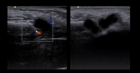 Usg Showed A Pus Filled Localized Swelling In The Soft Tissue With Deep
