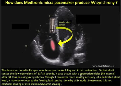 Video Dr P K Hazra On Linkedin Medtronic Double Chamber Micra