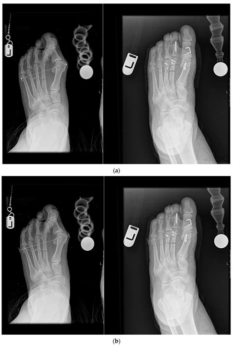 Hallux Valgus Repair With Chevron Osteotomy Significantly Narrows