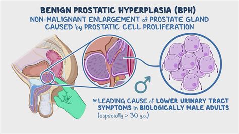 Benign Prostatic Hypertrophy And Prostate Cancer Video And Meaning Osmosis