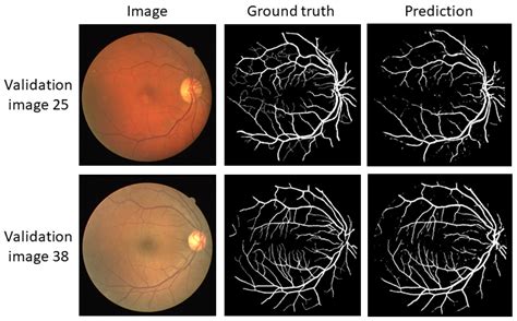 Deep Learning Architectures For Diagnosis Of Diabetic Retinopathy