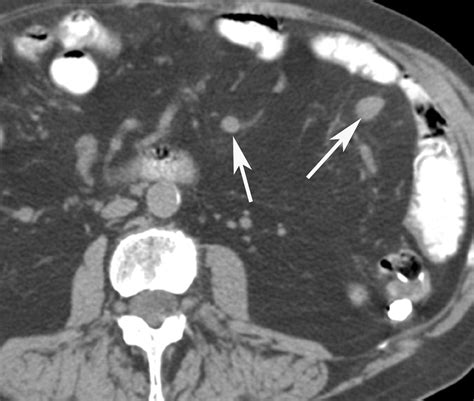 Mesenteric Lymph Nodes Seen At Imaging Causes And Significance