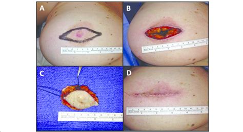 Surgical Excision A Planned Elliptical Shaped Surgical Excision Site Download Scientific