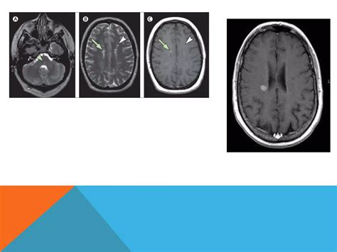 Clinically Isolated Syndromepptx